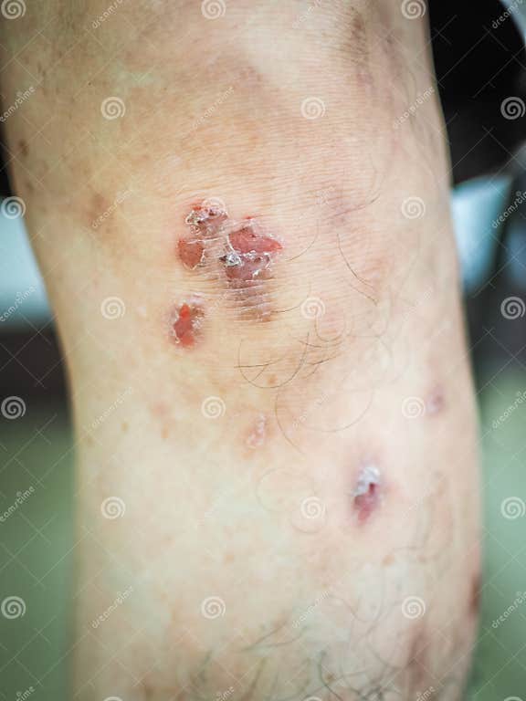 The Scabs of the Dermatologist on the Knee Stock Image - Image of ...