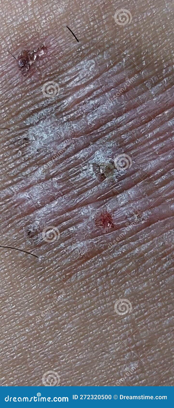 Scabs, Ringworm, Fungus on a Person& X27;s Leg Stock Photo - Image of ...