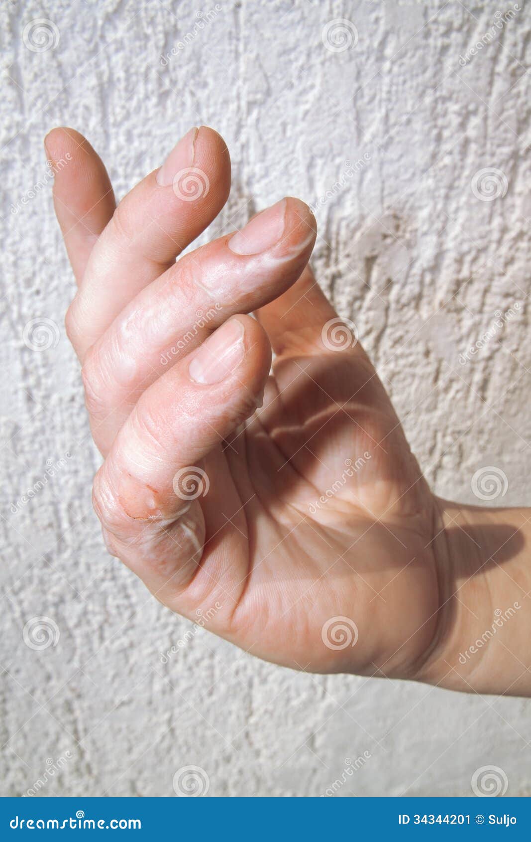 Scald on Fingers stock image. Image of burn, painful - 34344201