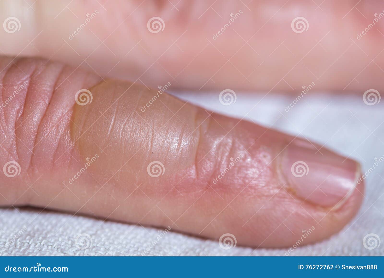 Scalded Hand. Blister on Your Finger Stock Photo - Image of lubricate ...