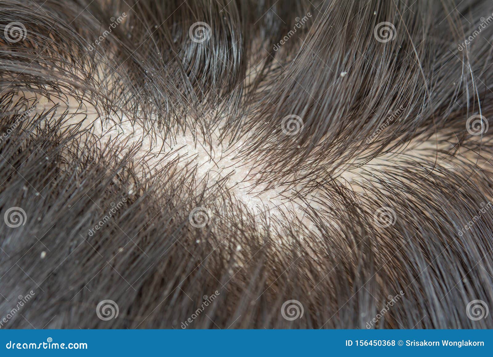 Scalp and Dandruff Skin Problems Stock Photo - Image of concept, flake ...