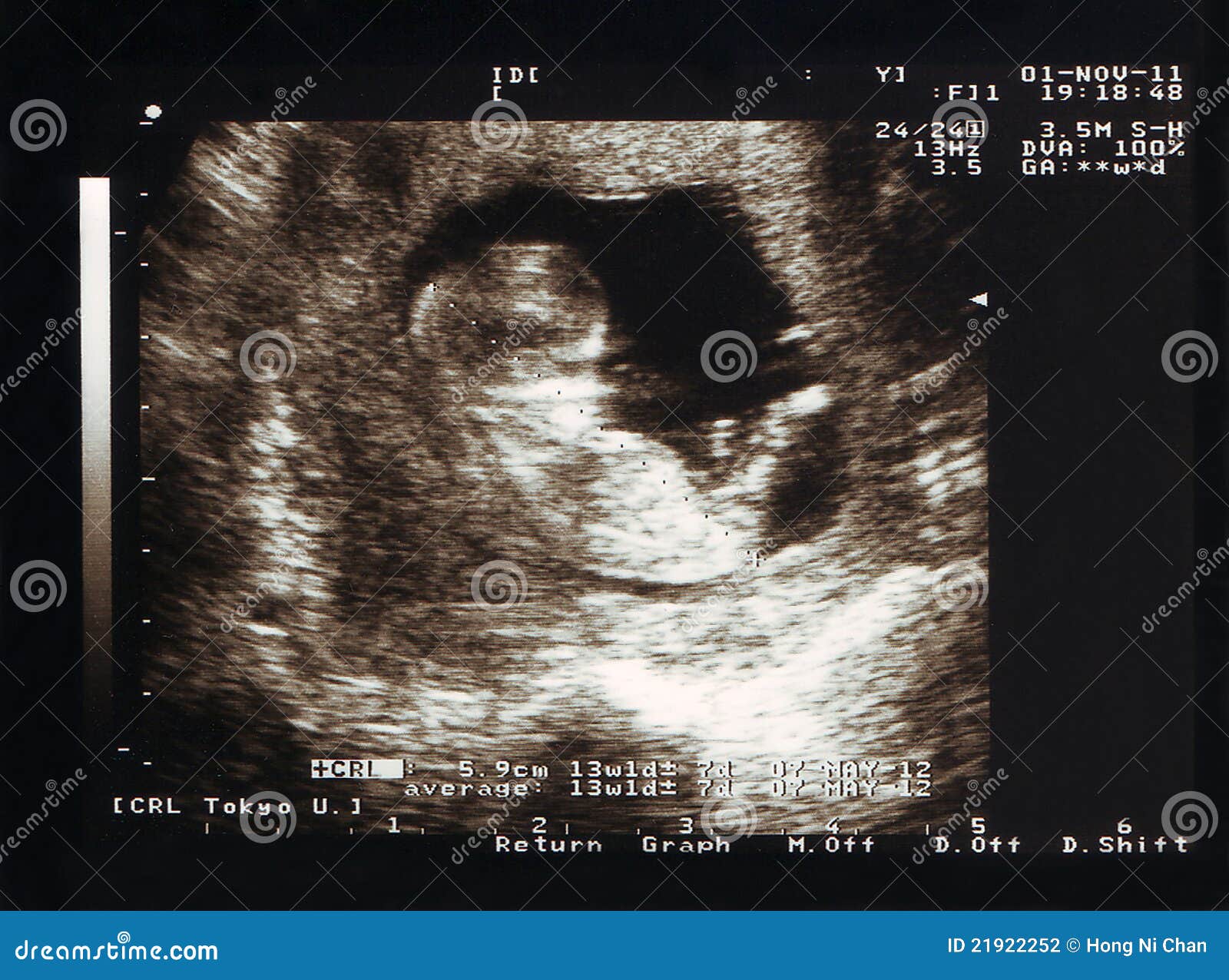 Scan on pregnancy, foetus stock photo. Image of graphic - 21922252