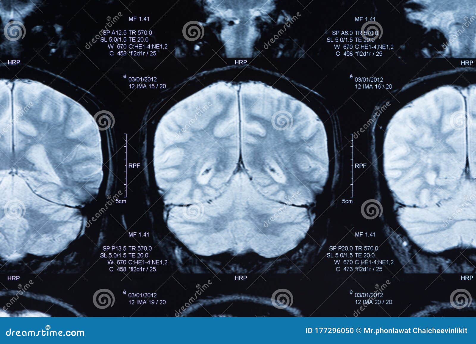Scanner du cerveau photo stock. Image du technologie - 177296050