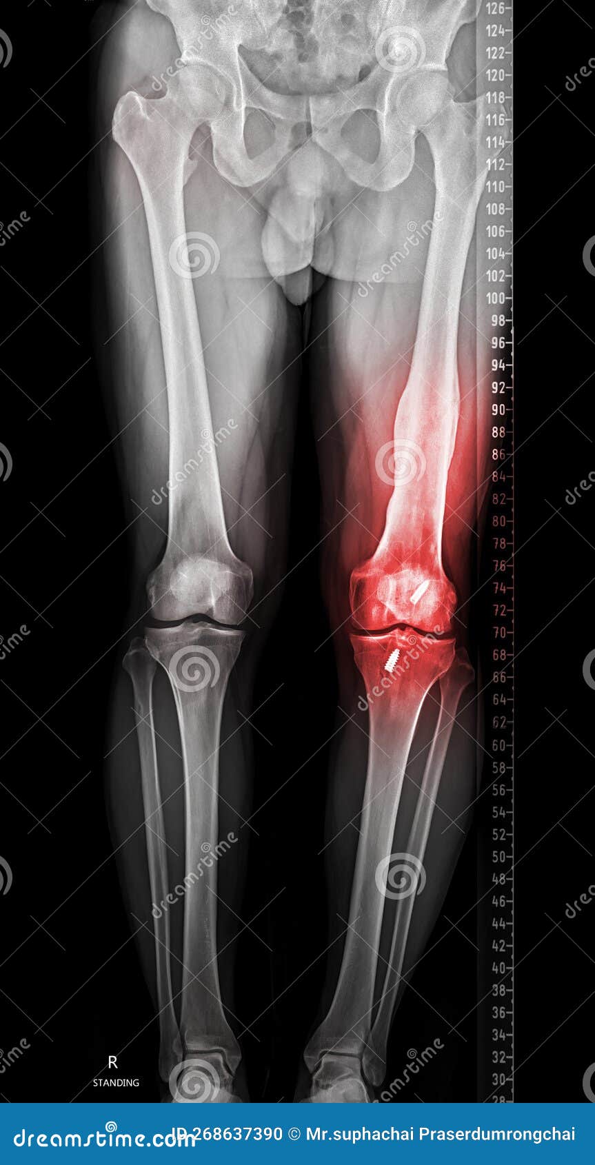 Scanogram is a Full-length Standing AP Radiograph of Both Lower ...