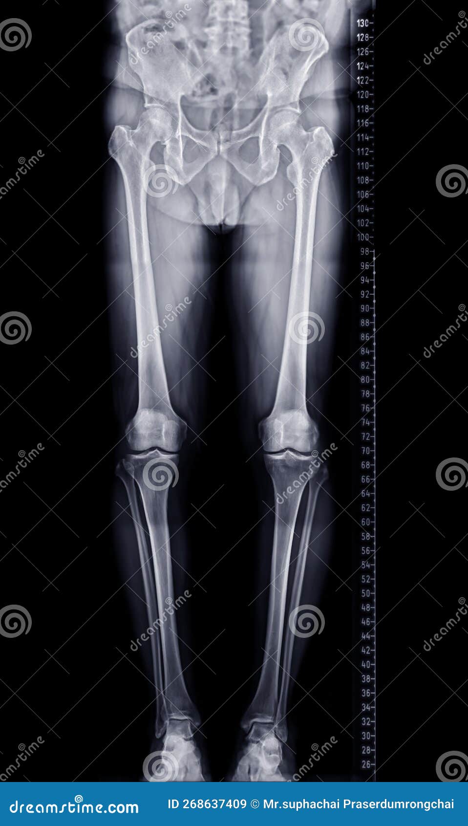 Scanogram is a Full-length Standing AP Radiograph of Both Lower ...