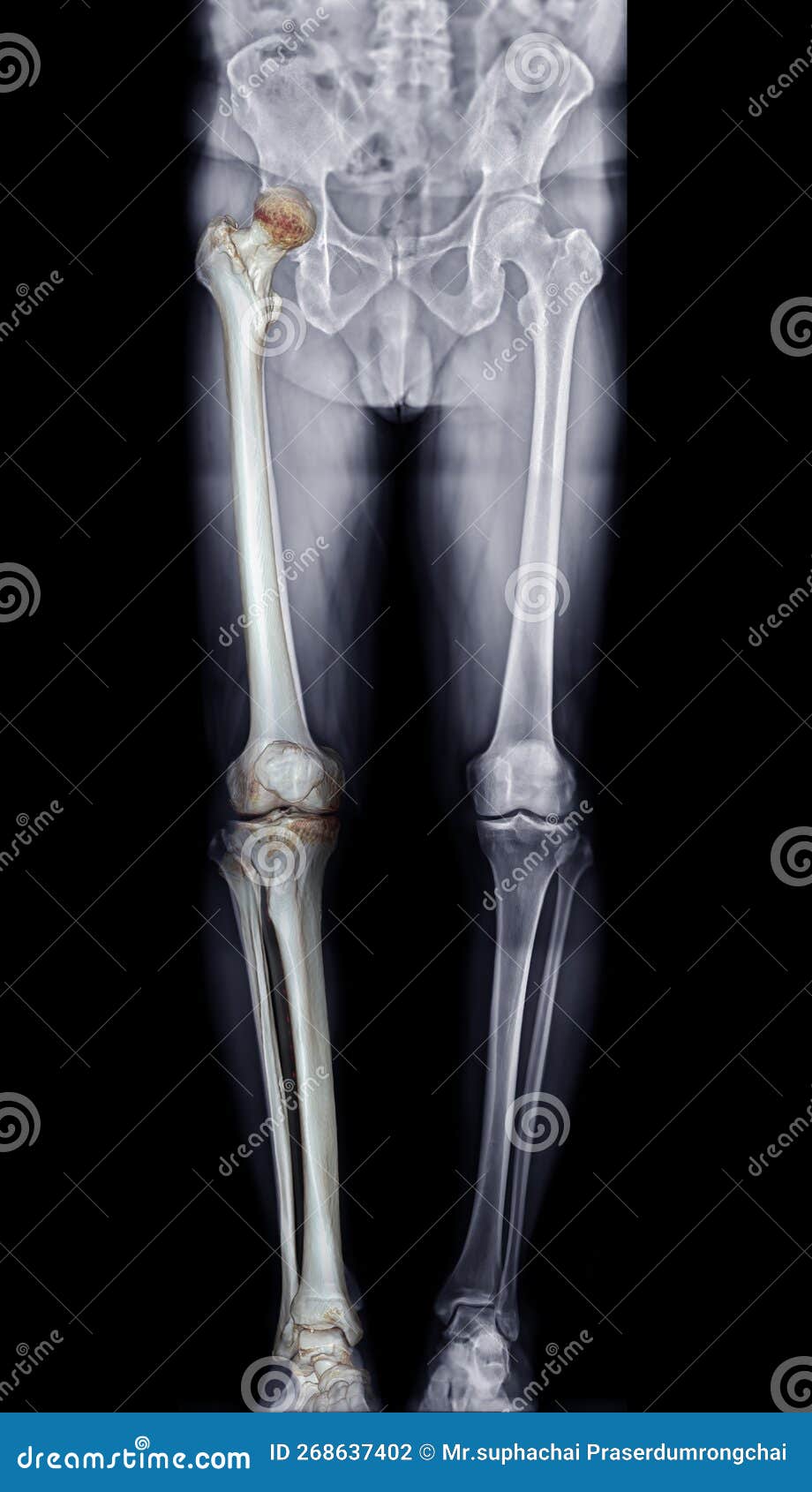 Scanogram is a Full-length Standing AP Radiograph of Both Lower ...