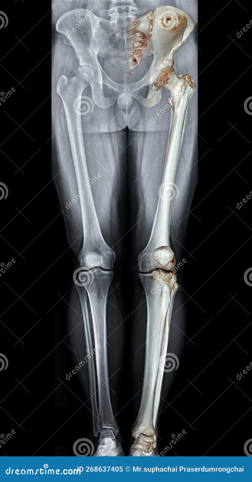 Xray Scanogram Youtube Scanogram Both Lower Limb🏥 . . #xray_doctor