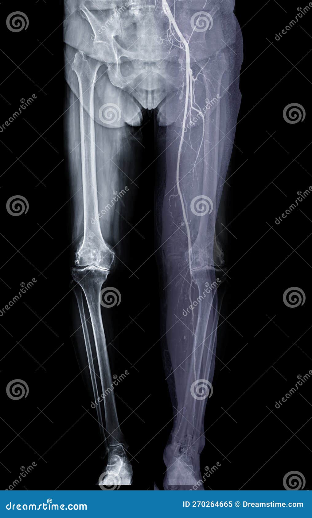 Scanogram Image Fusion with CTA Lower Extremities Stock Image - Image ...