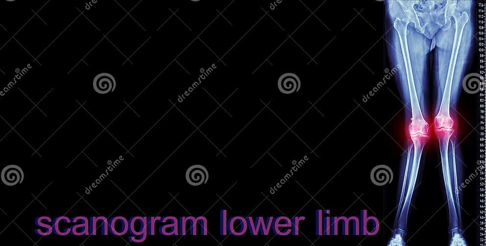 Scanogram or X-ray Image of Lower Extremity for Diagnostic Joint ...