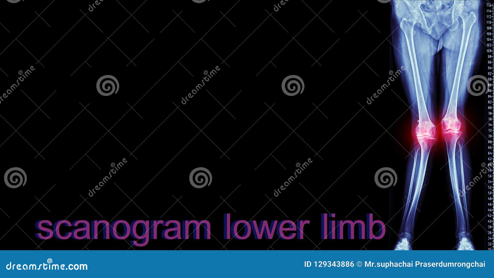 Scanogram Of Lower Limb Or X-ray Image Of Total Lower Extremity With ...