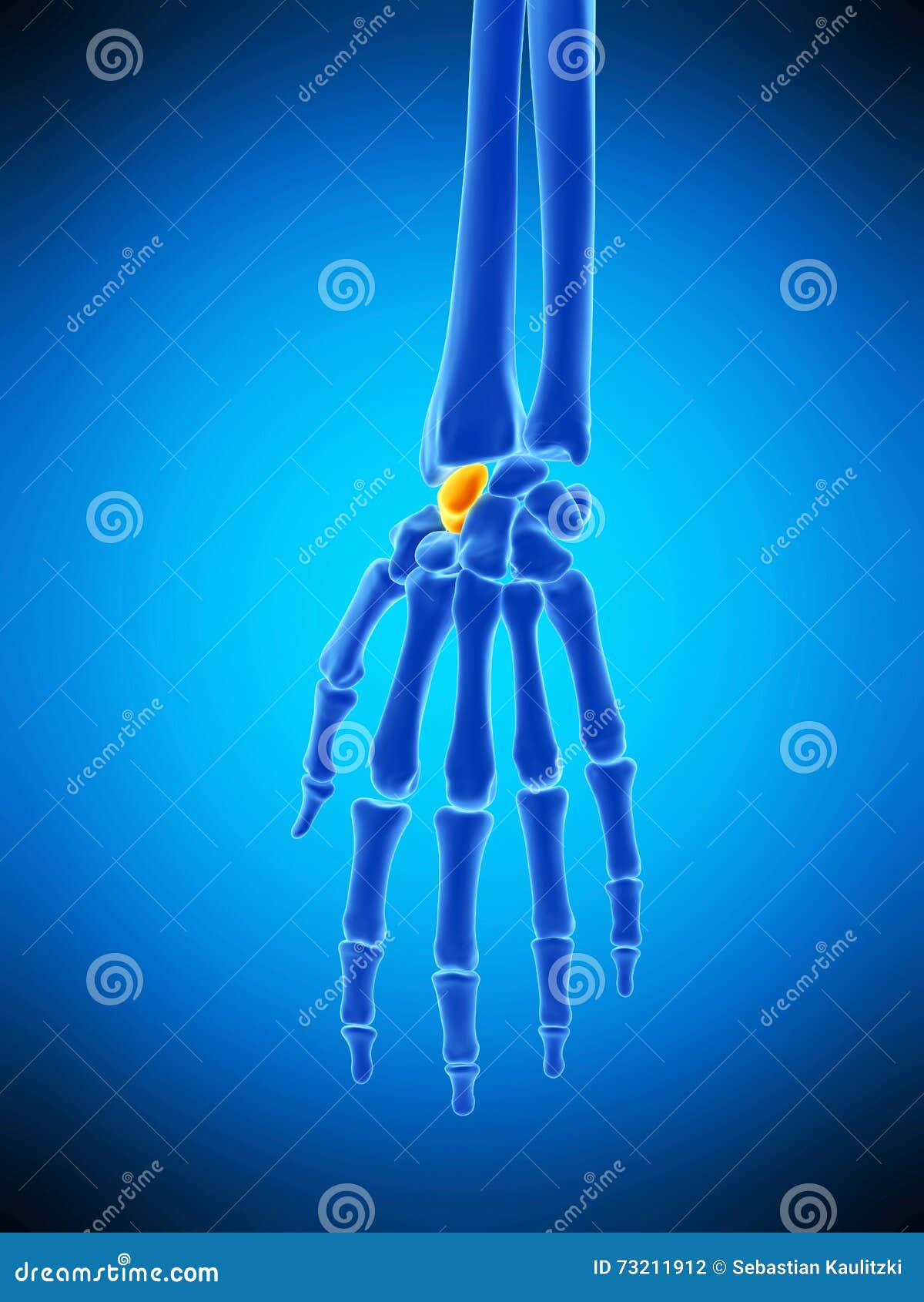 Scaphoid Bone Fracture Medical Illustration On White Background ...