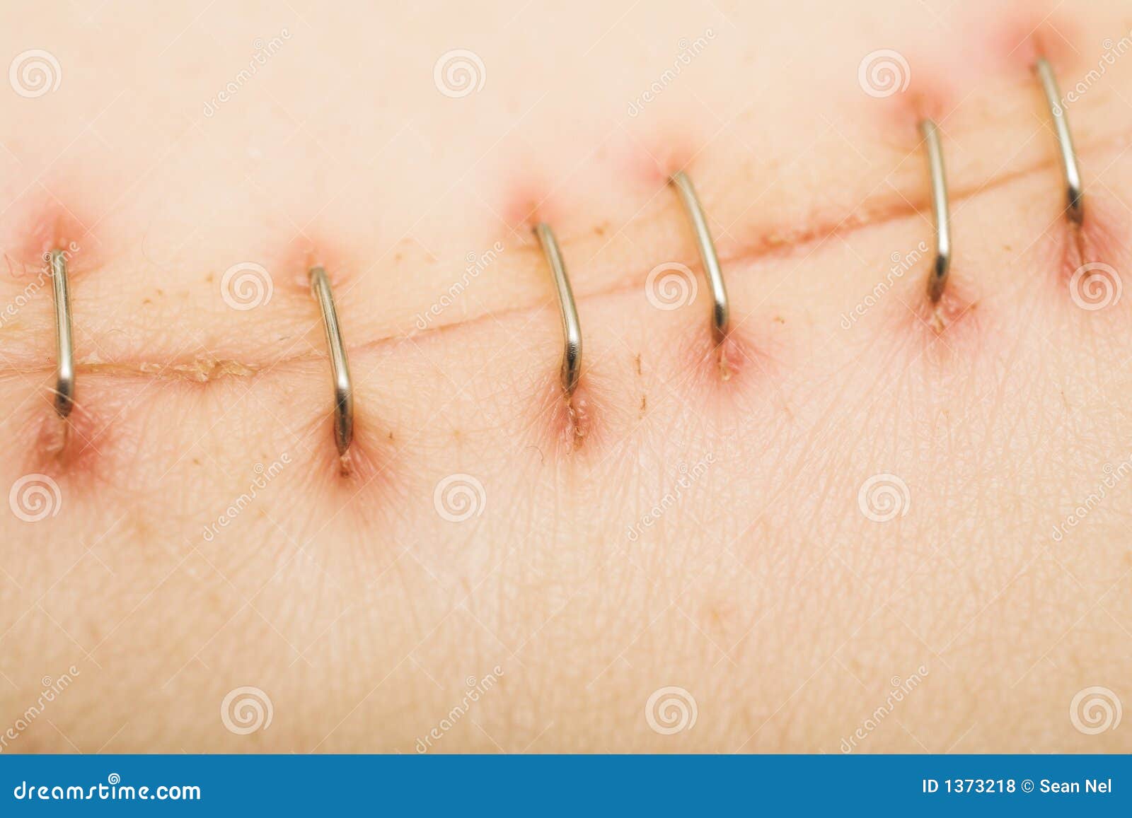 Laparoscopic Tubal Ligation Scars