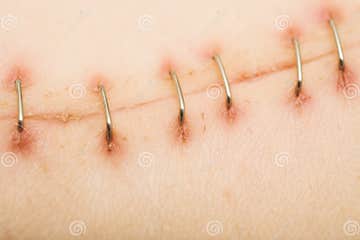 Scar #1 stock photo. Image of pain, stitches, scar, medical - 1373218
