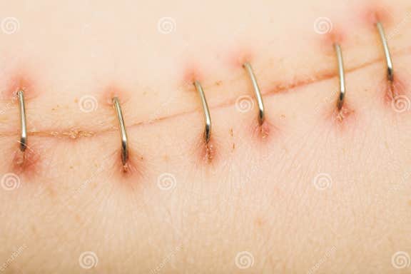 Scar #1 stock photo. Image of pain, stitches, scar, medical - 1373218