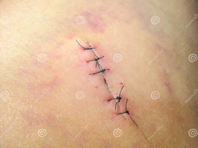 Scar stock image. Image of hurt, heal, medical, stitches - 11908451
