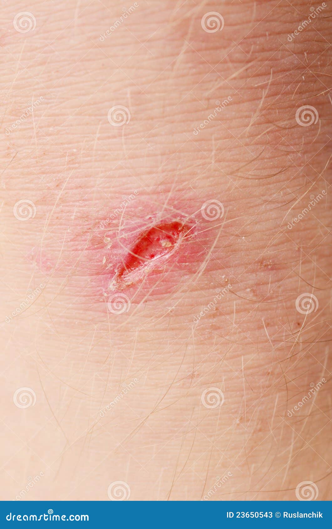 Scar stock image. Image of human, bloody, health, result - 23650543
