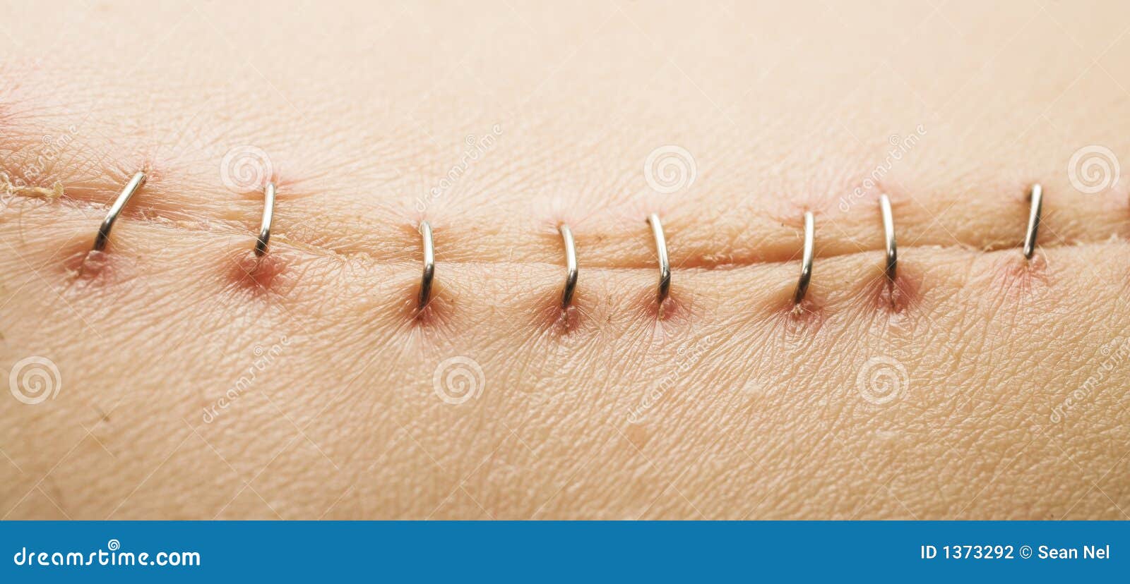 Scar #3 stock photo. Image of clip, operation, bruise - 1373292