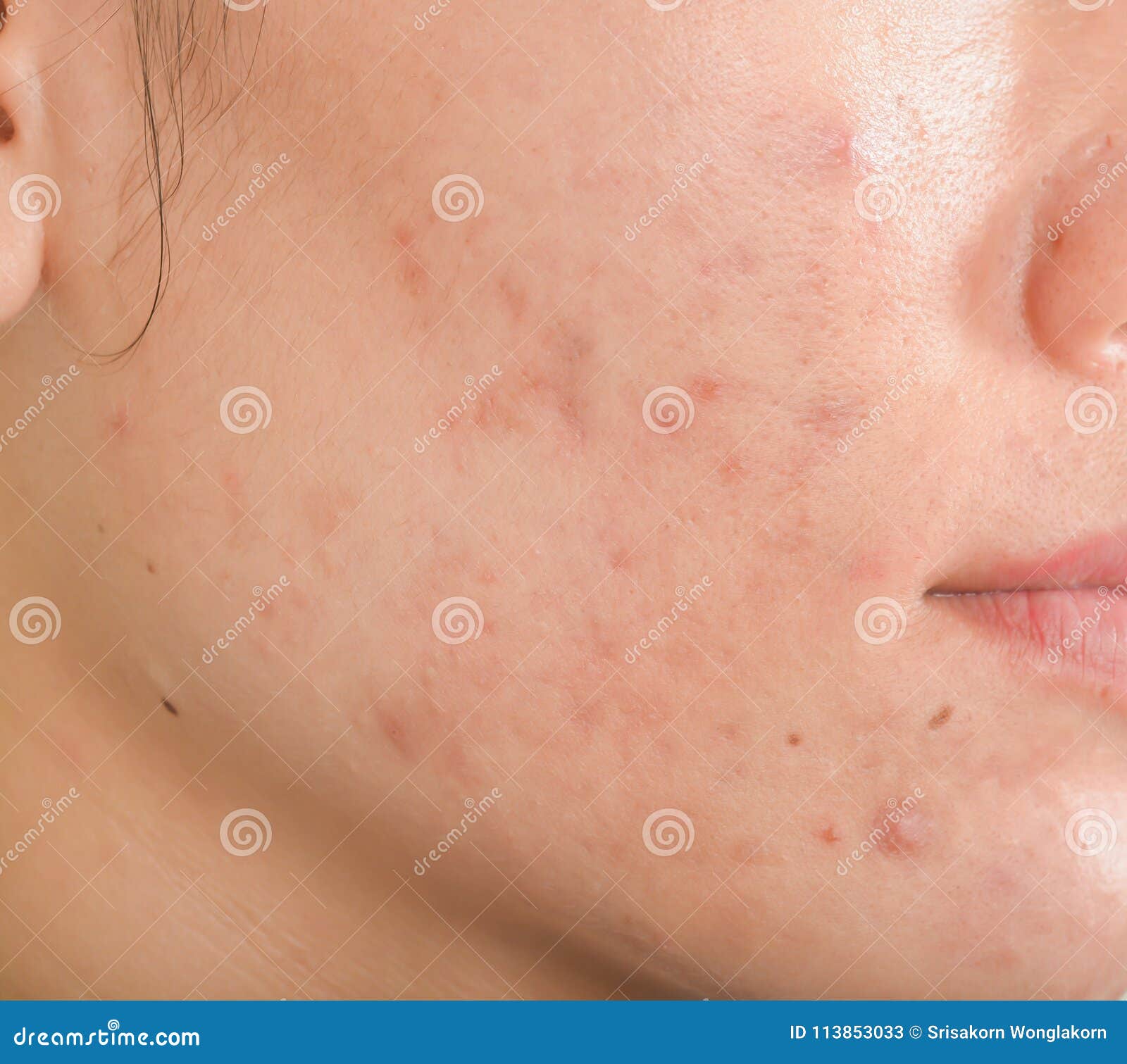 Scar and Black Spots on Face Stock Image - Image of face, skincare ...