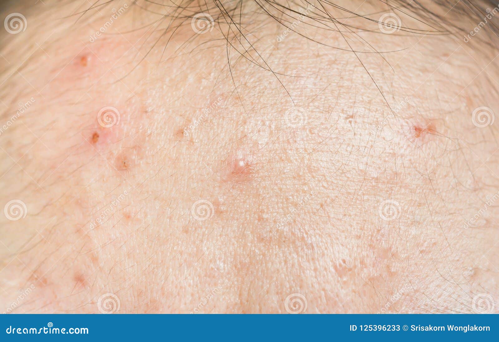 Scar from Acne on face stock image. Image of beauty - 125396233