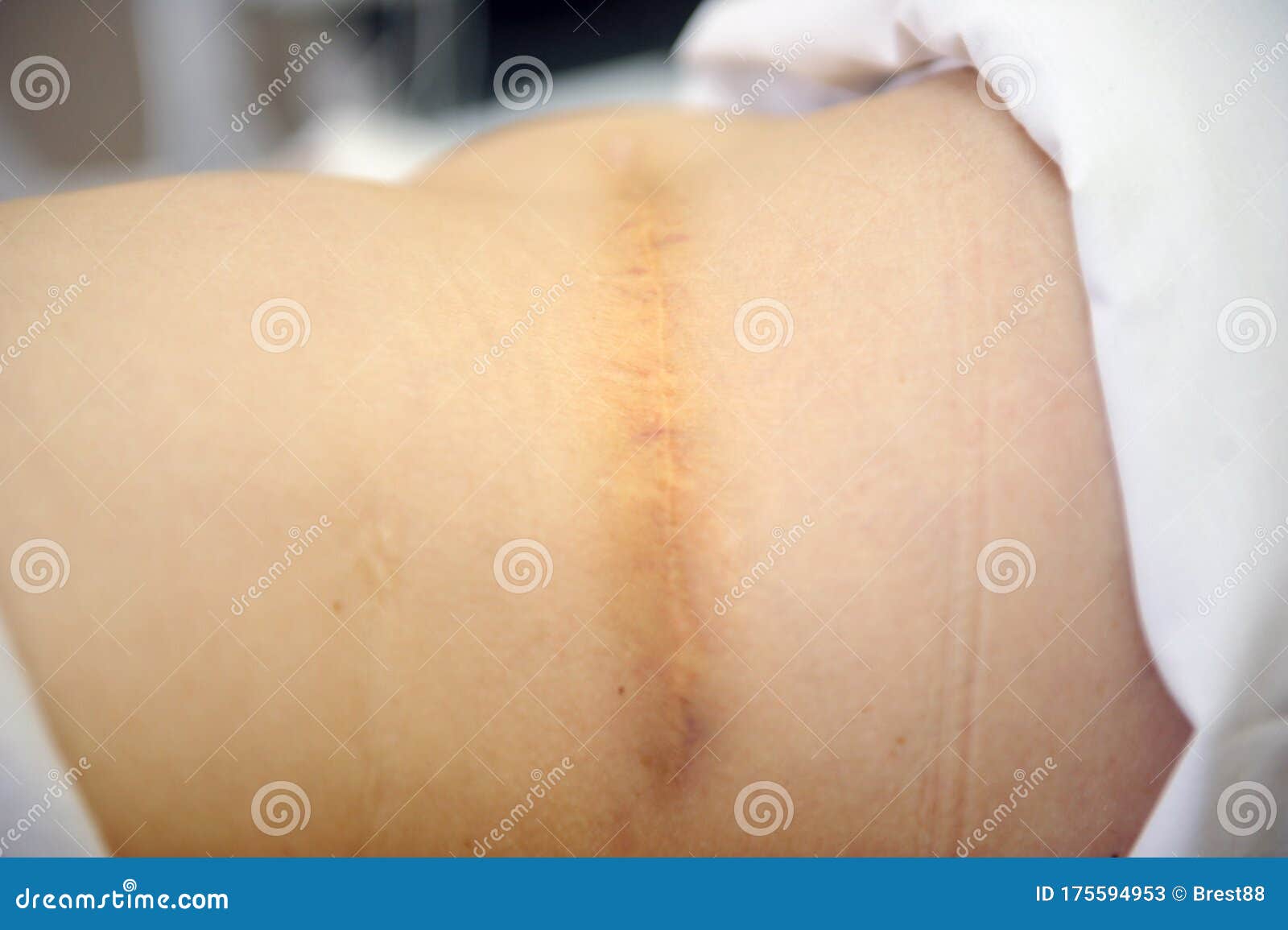 A Scar of Appendicitis on the Abdomen of a Woman Stock Image - Image of ...