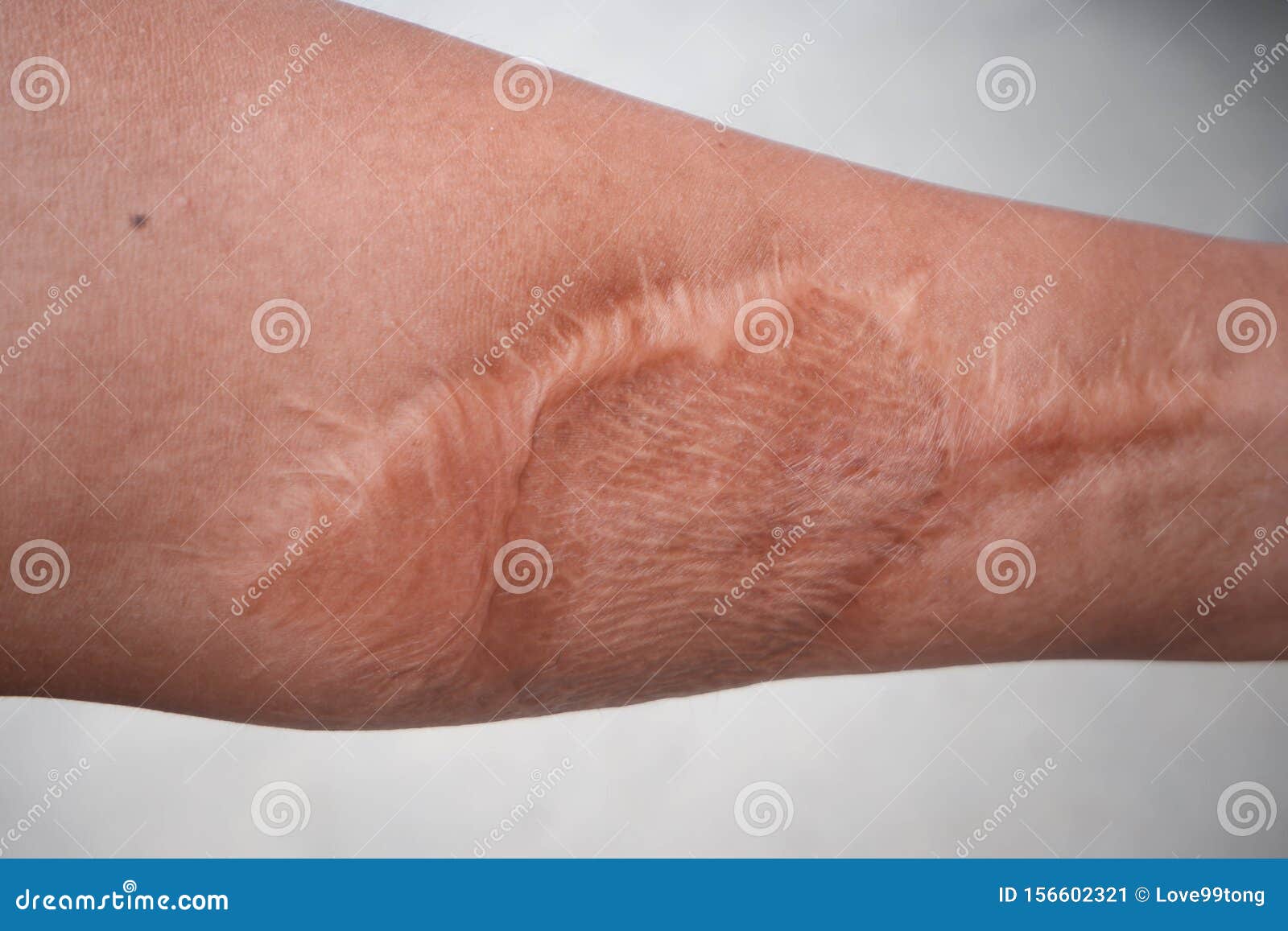 Scar on the arm stock image. Image of surgery, wound - 156602321