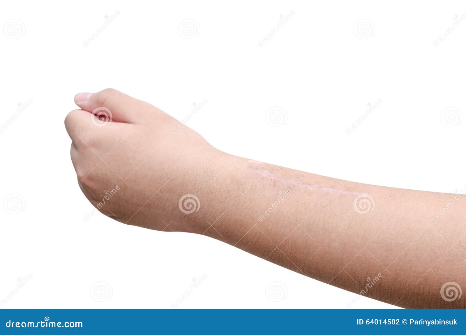 Scar at arm from operation stock photo. Image of hands - 64014502