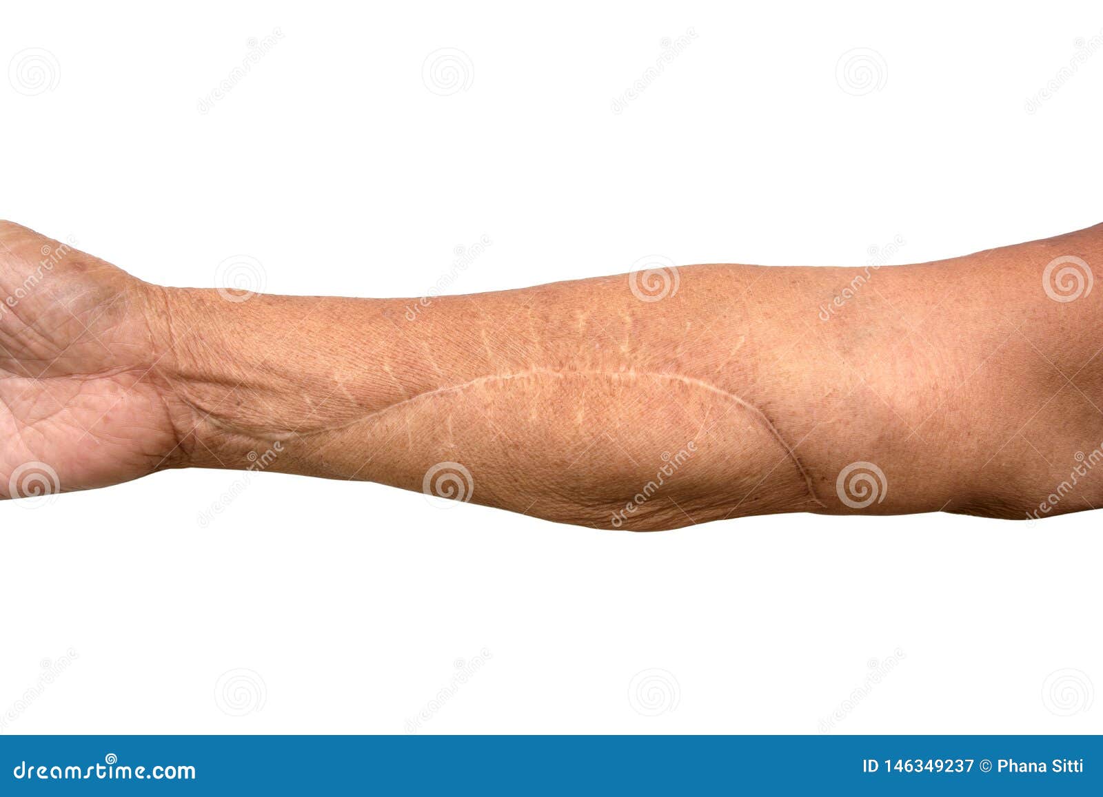 Scar on Arm after Operation Isolated on White Background Stock Image ...