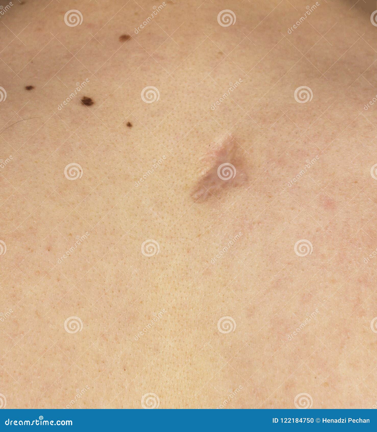 Scar on the Back of a Man, Close-up Temple Stock Photo - Image of ...