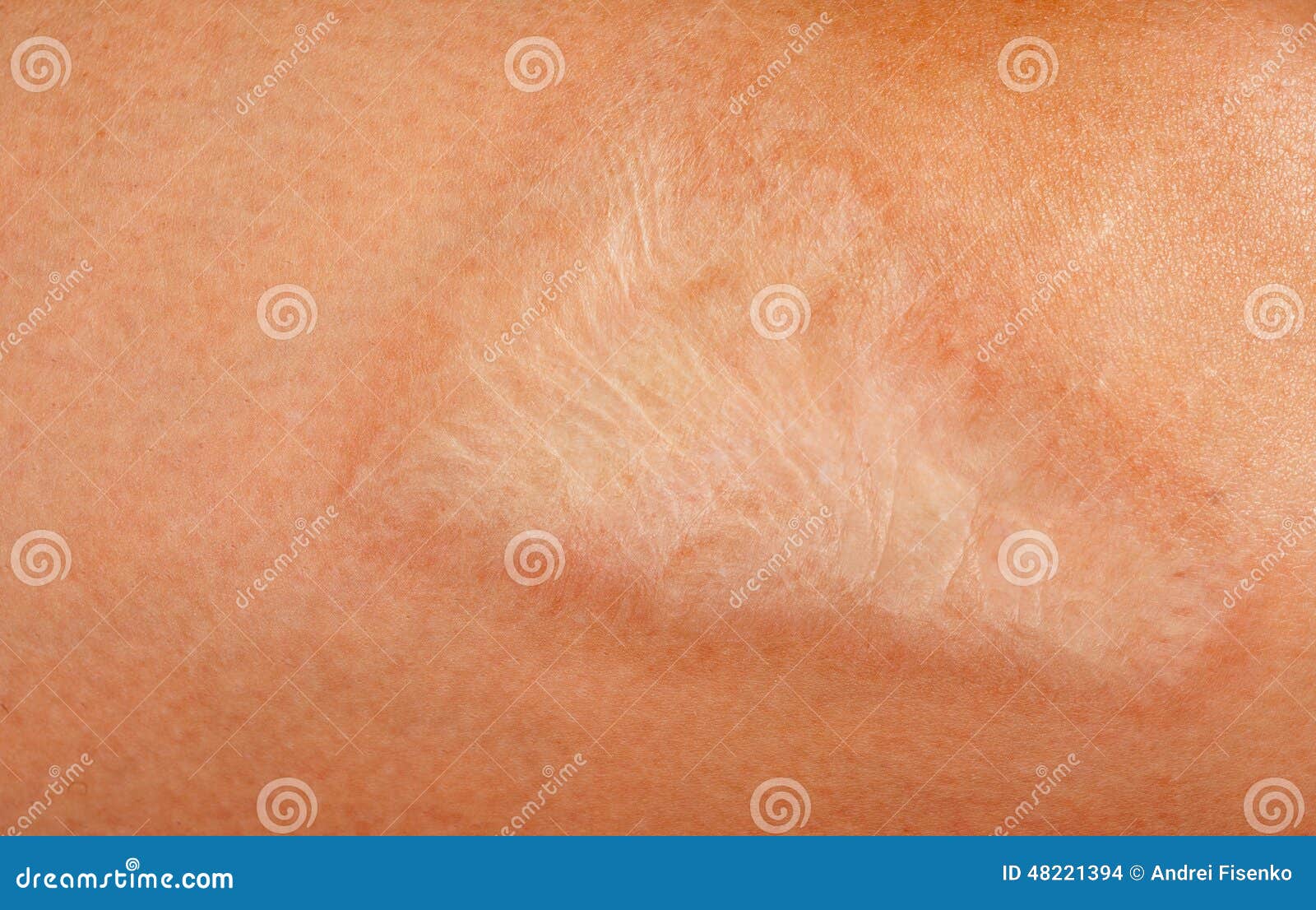 Scar on the body stock photo. Image of medicine, health - 48221394