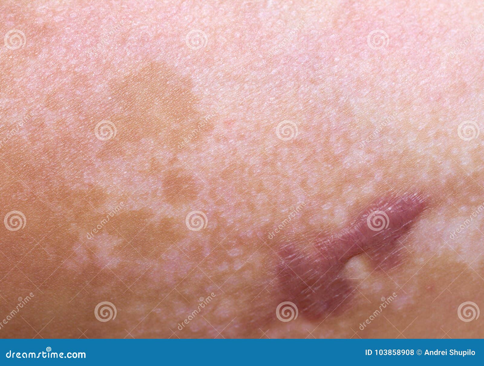 Scar from a Burn on the Skin Stock Photo - Image of damage, medicine ...
