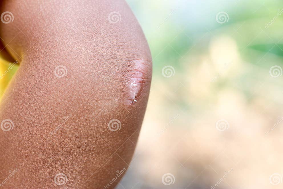 Scar on the Elbow of the Child Stock Photo - Image of dermatology ...