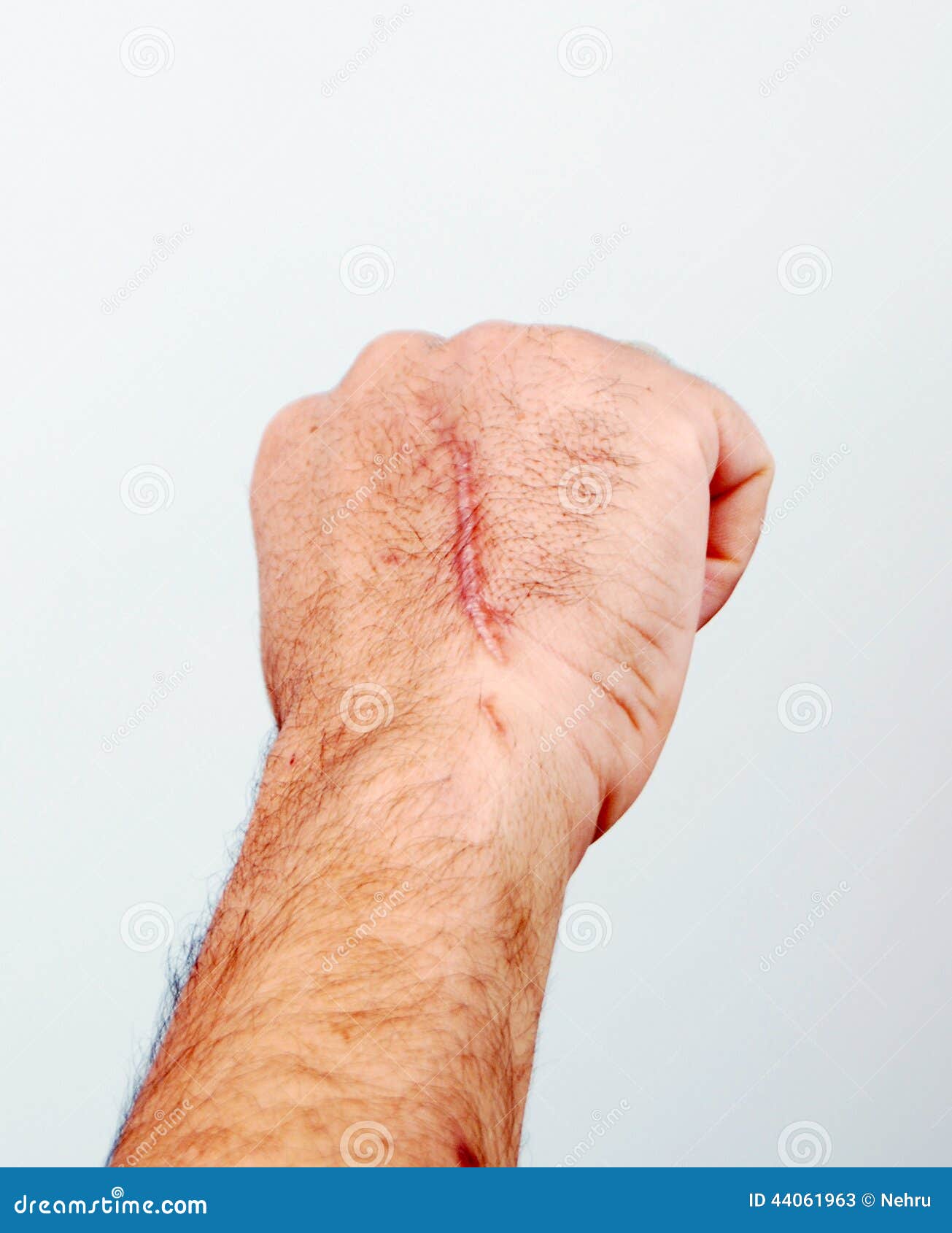 Scar hand stock image. Image of ailment, operation, incision - 44061963