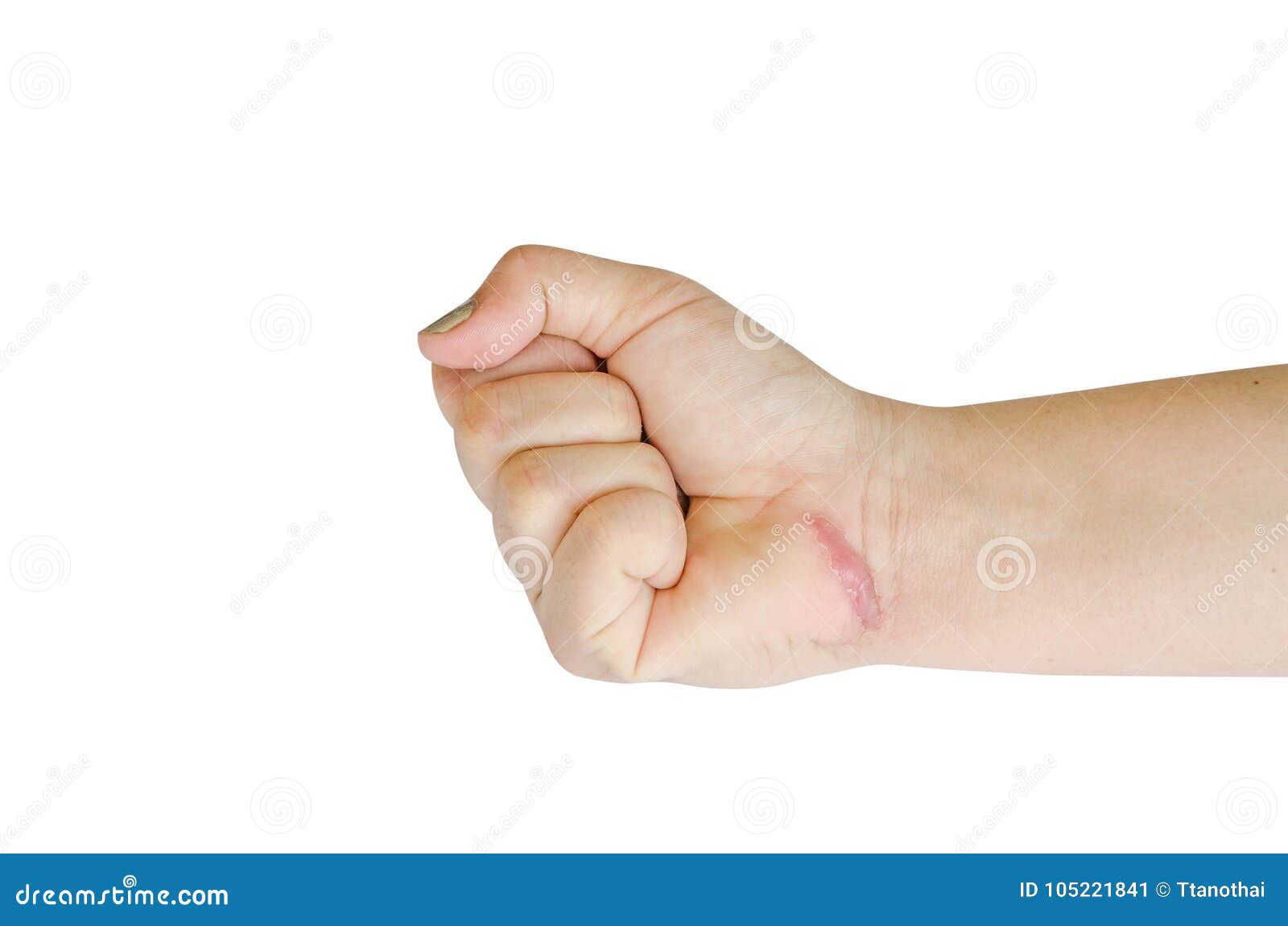 Man Arm And Hand With Keloid Scar, Hypertrophic Scar On Skin Royalty ...