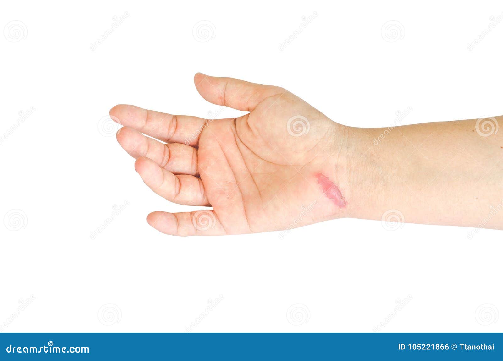 Man Arm And Hand With Keloid Scar, Hypertrophic Scar On Skin Royalty ...