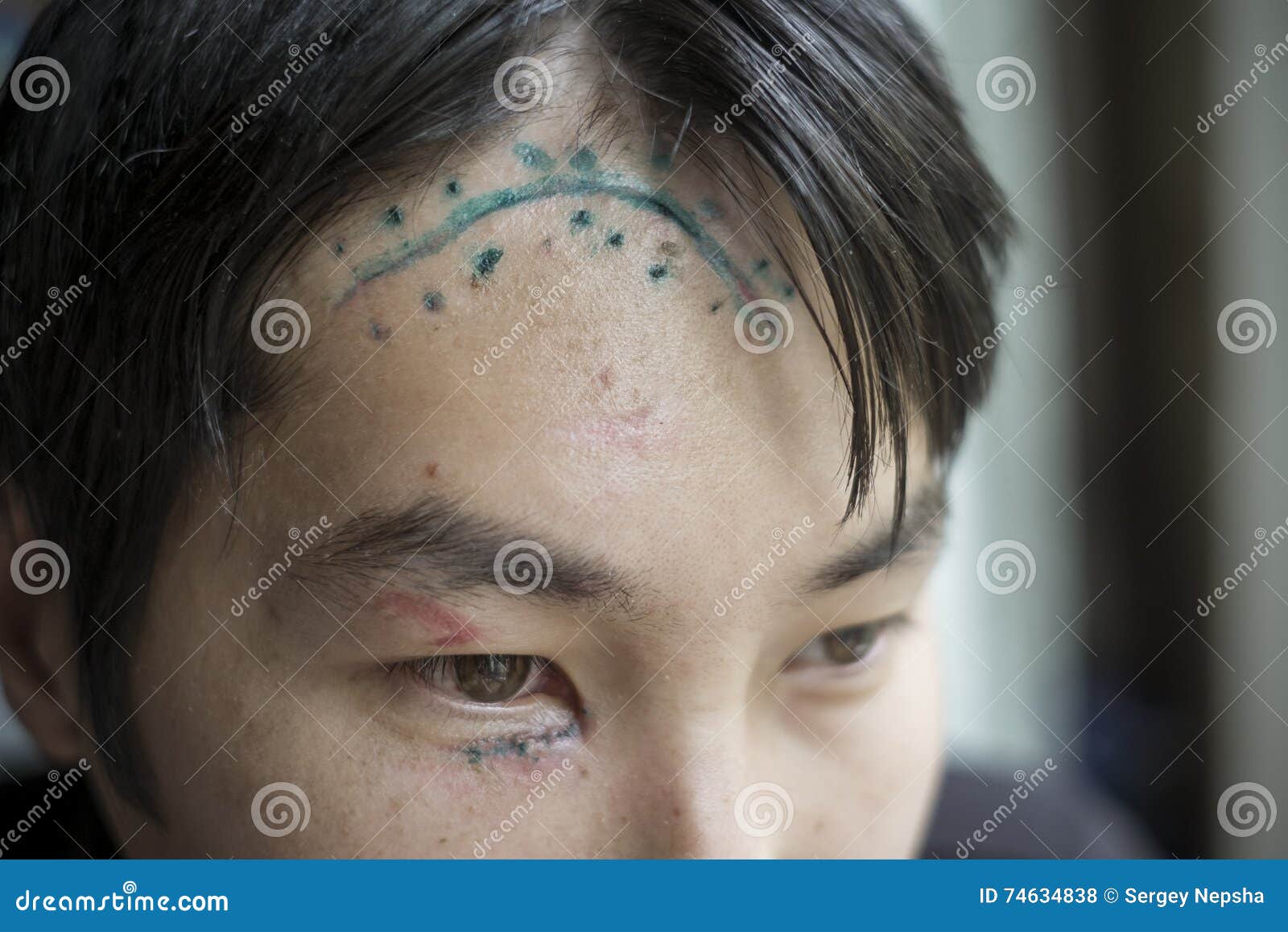 Scar on the head stock photo. Image of injury, close - 74634838