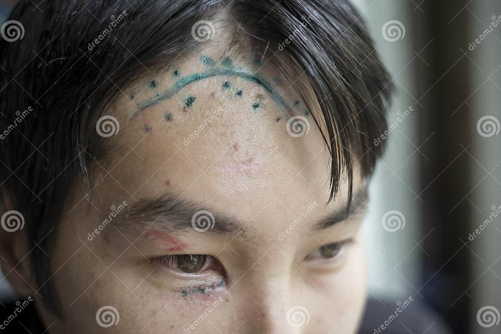 Scar on the head stock photo. Image of injury, close - 74634838