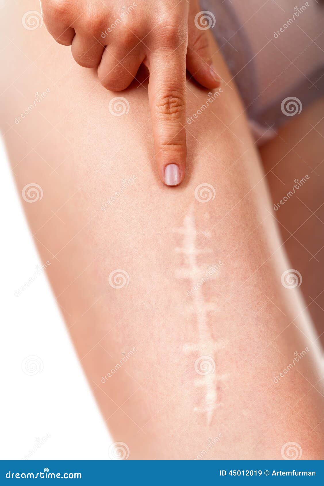 Scar stock image. Image of healthy, incision, correction - 45012019