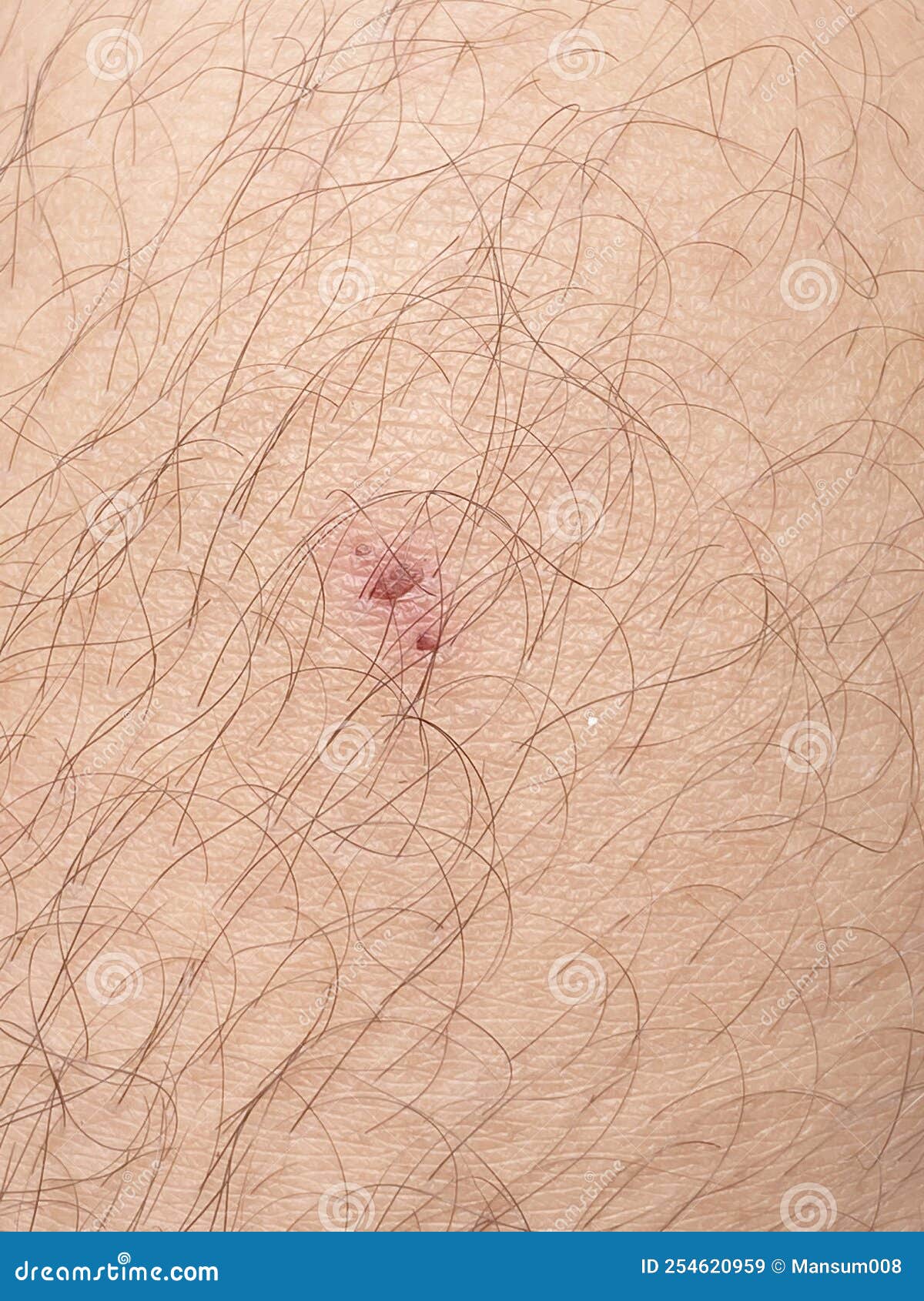 Scar on human body stock image. Image of macro, hair - 254620959