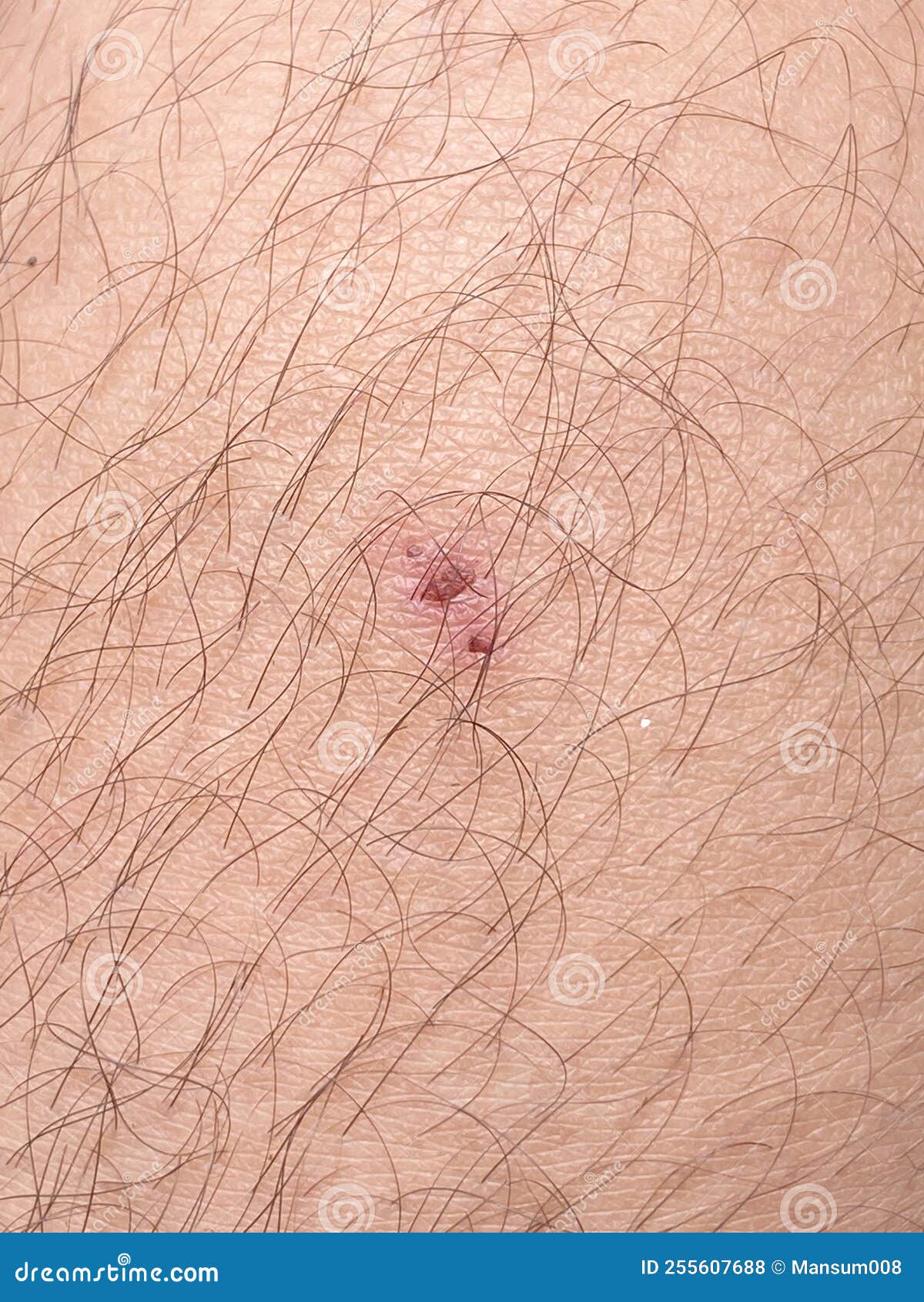 Scar on human skin stock photo. Image of disease, human - 255607688