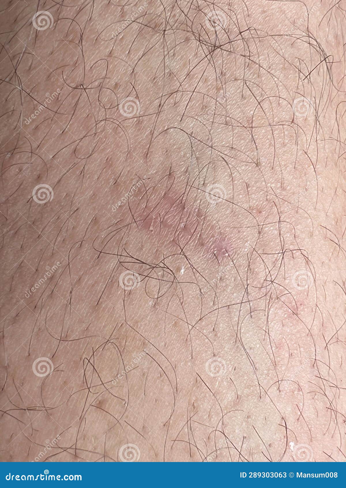 Scar on the human skin stock image. Image of closeup - 289303063