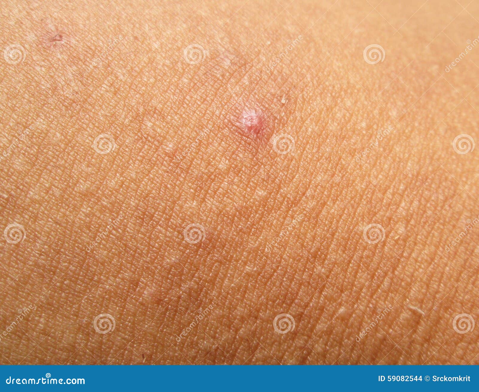 Scar on human skin stock photo. Image of skin, scar, healthcare - 59082544
