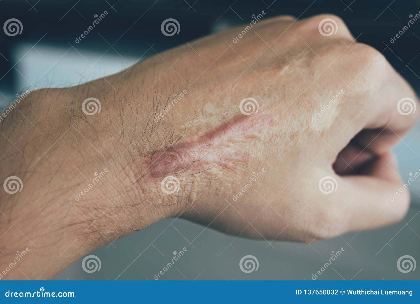 Man Arm And Hand With Keloid Scar, Hypertrophic Scar On Skin Royalty ...