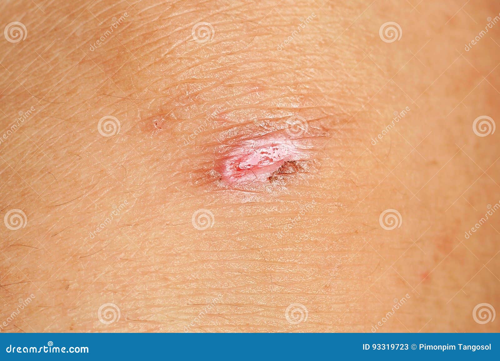 Scar on the knee stock image. Image of illness, senior - 93319723