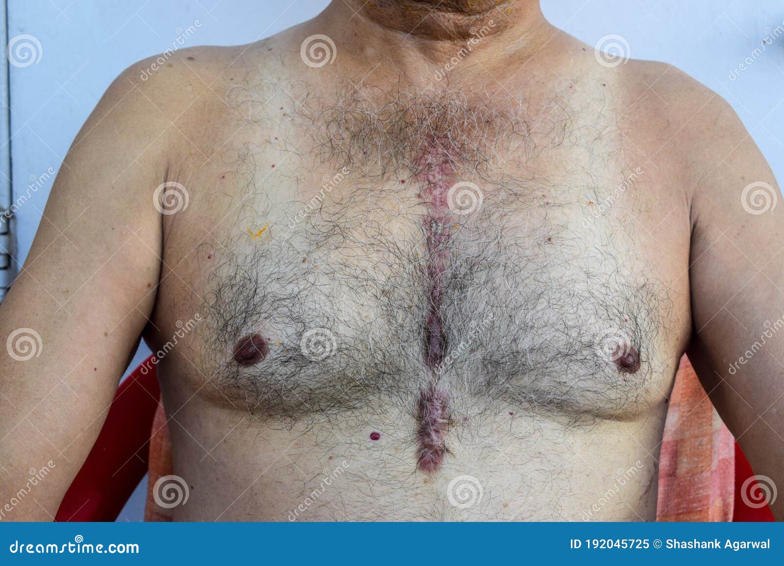 Scar Mark on the Chest of Male Body Stock Image - Image of male, scar ...