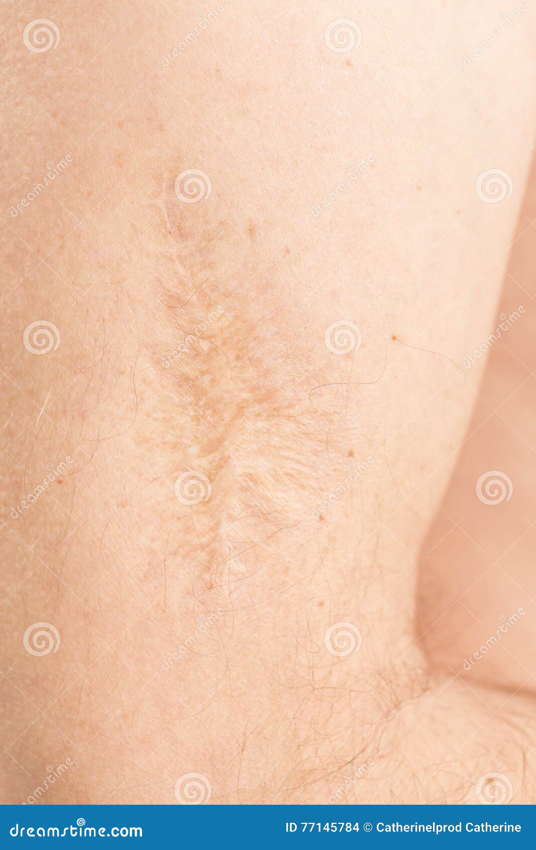 Scar after Operation on Arm Stock Photo - Image of rumen, operate: 77145784