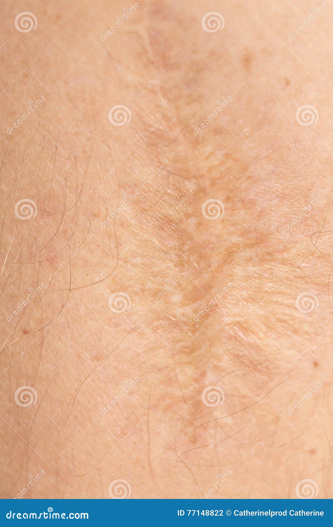 Scar after Operation on Arm Stock Photo - Image of cicatrix, healthcare ...
