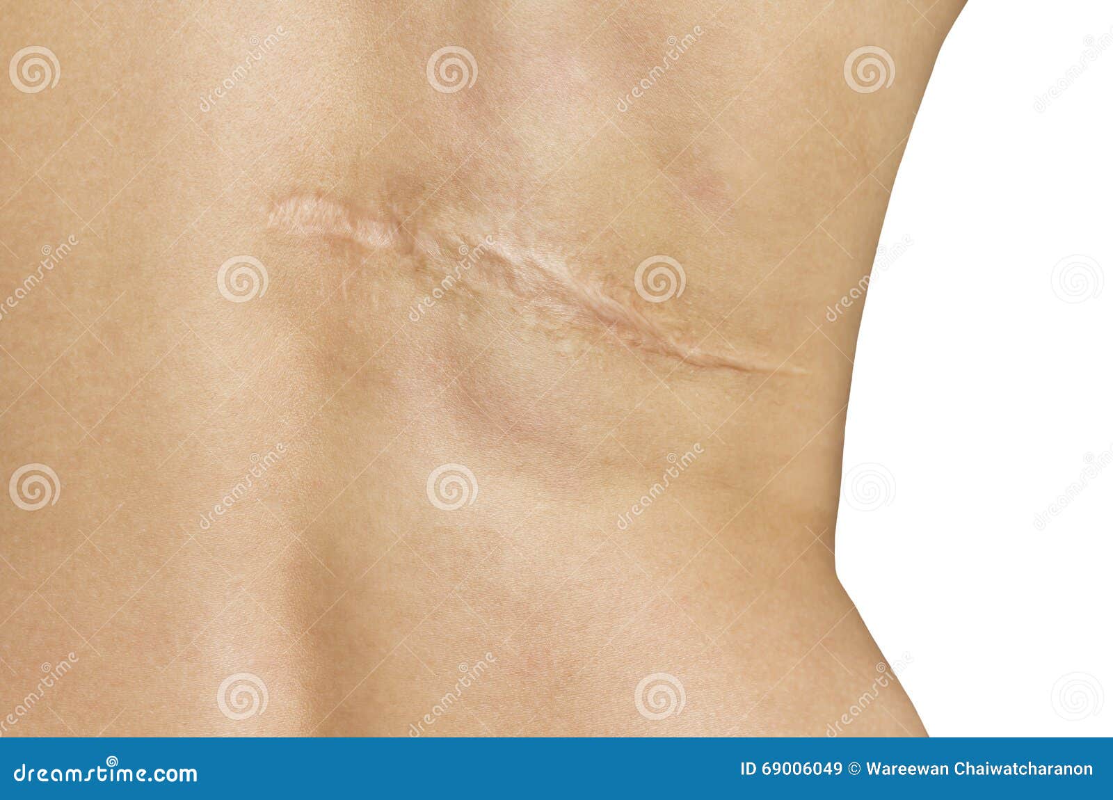 Scar On Arm After Operation Isolated On White Background Royalty-Free ...