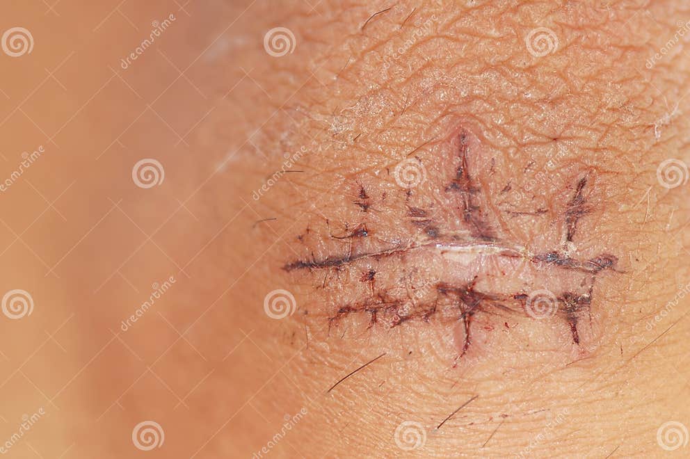 Scar From Recovering Stitches Stock Image Image Of Surgical Incision