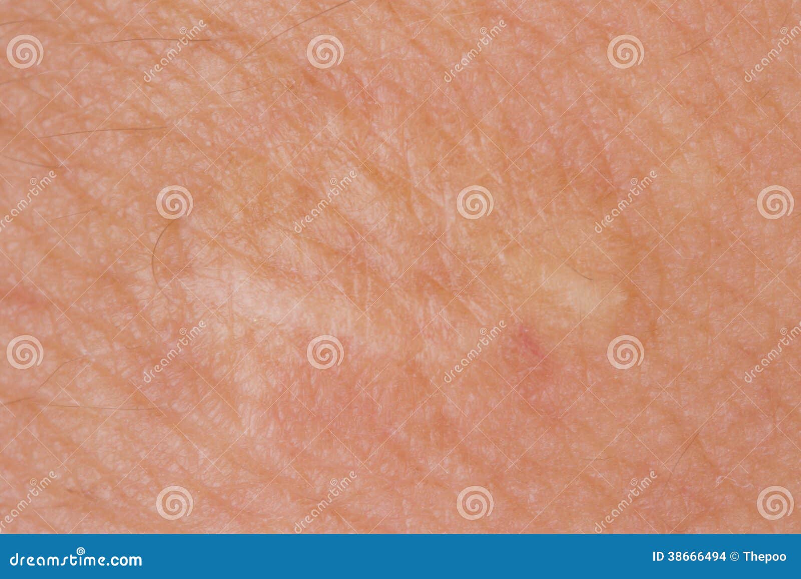 Scar stock photo. Image of injury, human, wound, medical - 38666494