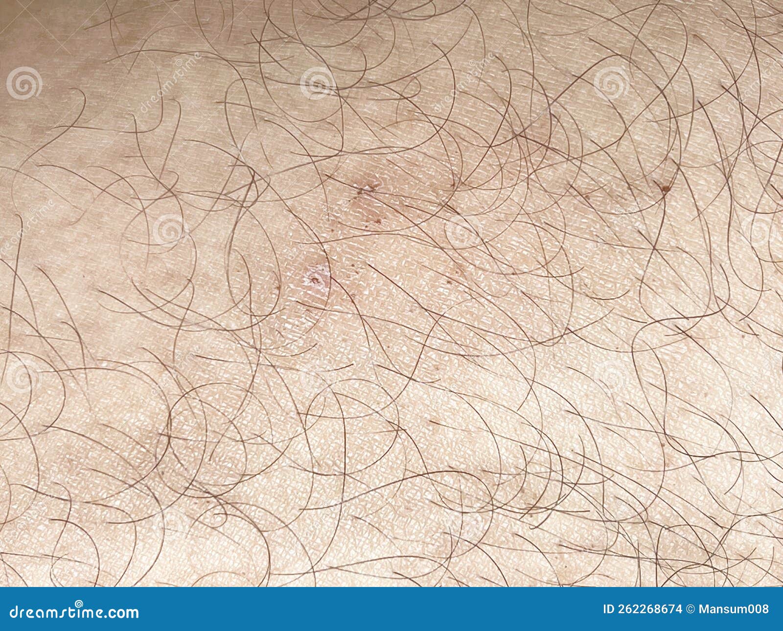 Scar on skin stock photo. Image of illness, dermatology - 262268674